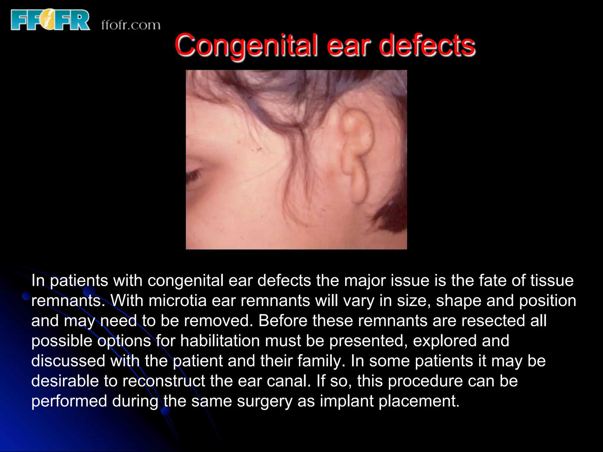 Restoration of ear defects | PDF