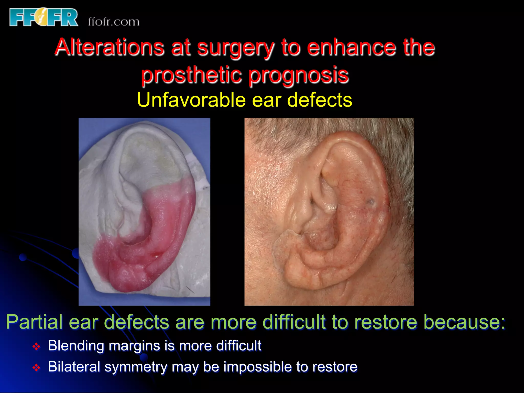 Restoration of ear defects | PDF