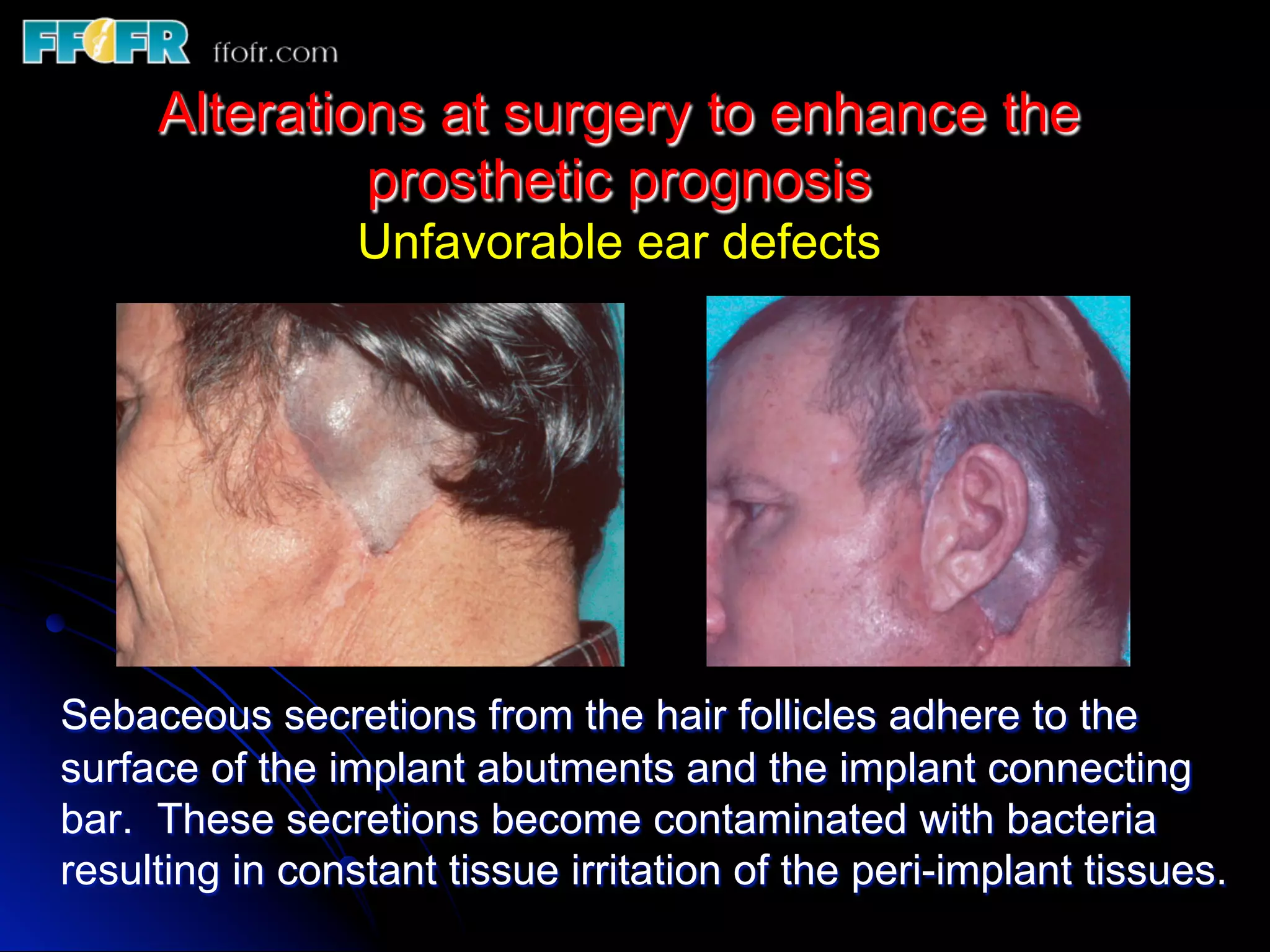 Restoration of ear defects | PDF