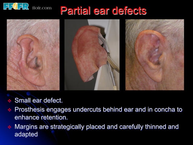 Restoration of ear defects | PDF