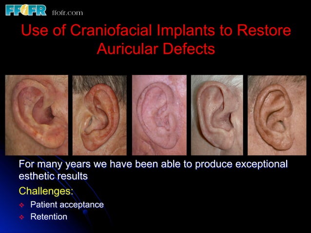 Restoration of ear defects | PDF