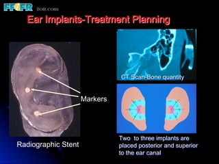 Restoration of ear defects | PDF
