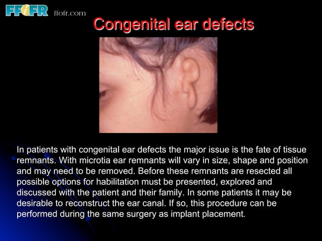Restoration of ear defects | PDF
