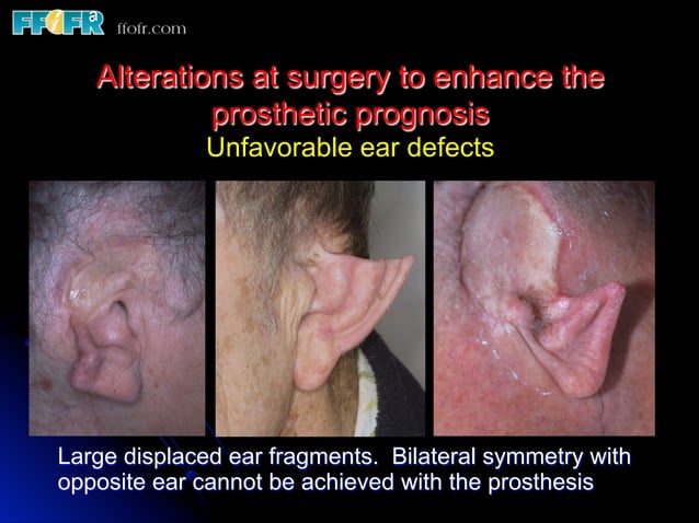 Restoration of ear defects | PDF