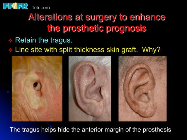 Restoration of ear defects | PDF