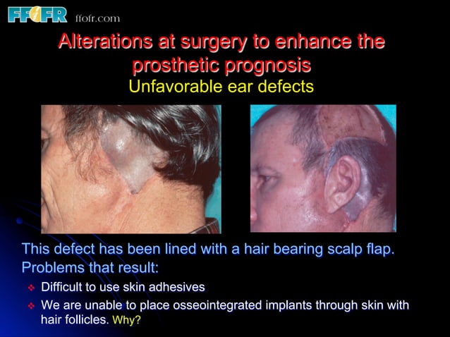 Restoration of ear defects | PDF