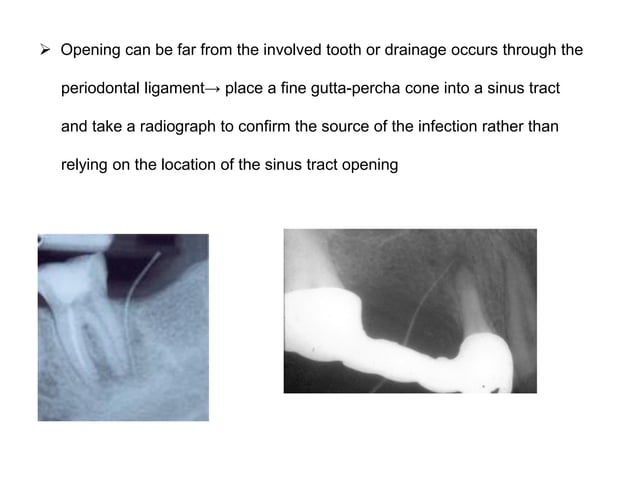 Restoration of endodontically treated teeth | PDF