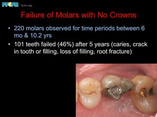 Restoration of endodontically treated teeth | PDF
