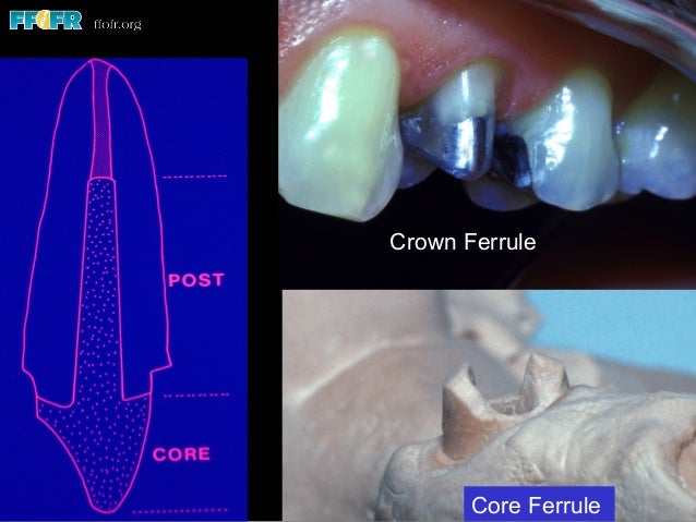 Restoration of endodontically treated teeth