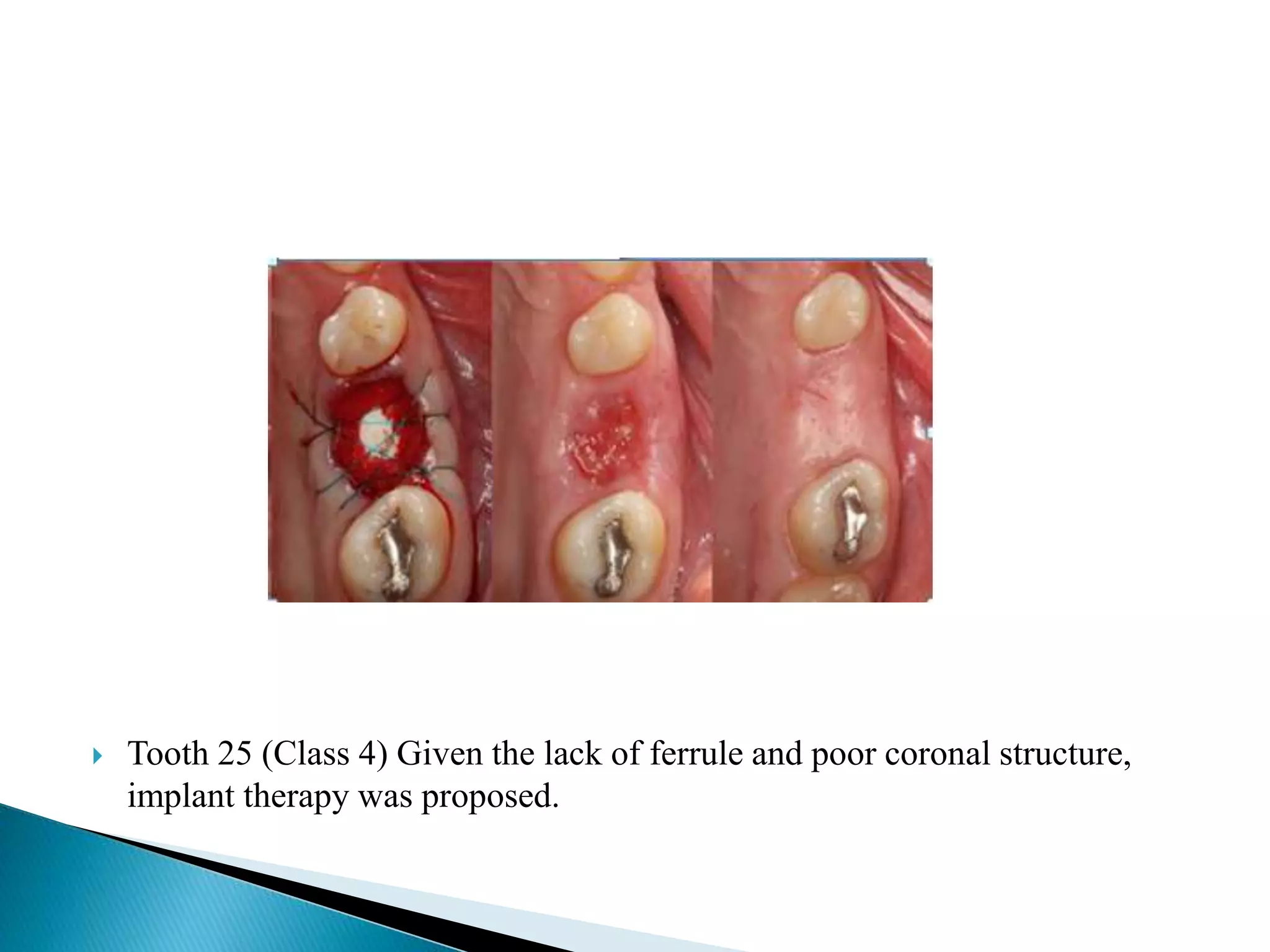 Restoration of endodontically treated teeth | PPTX