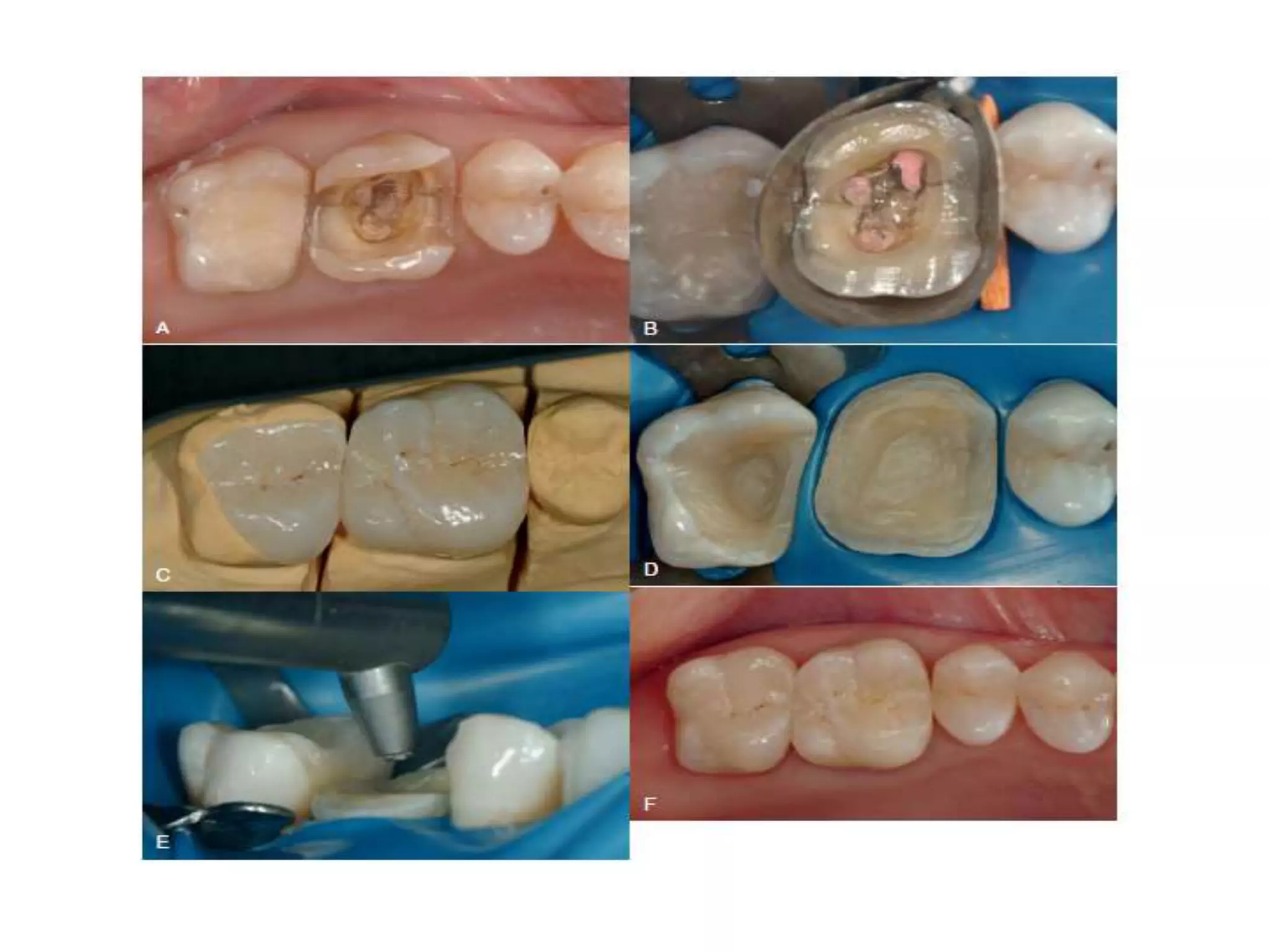 Restoration of endodontically treated teeth | PPTX