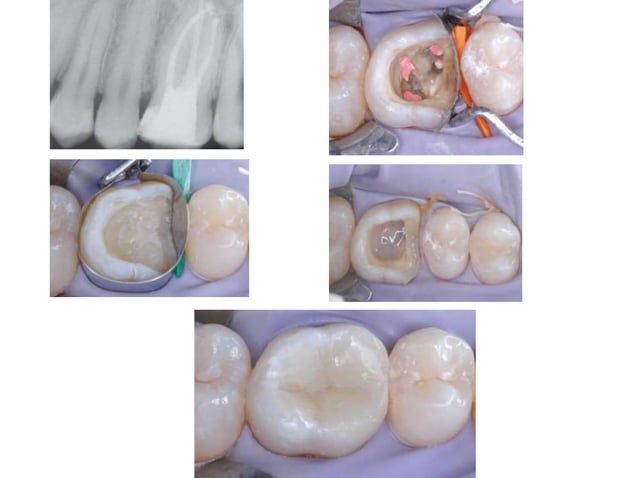 Restoration of endodontically treated teeth | PPTX