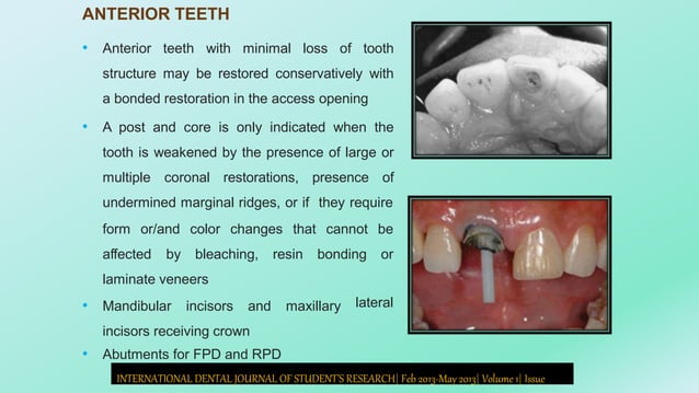 Restoration of endodontically treated teeth | PPTX