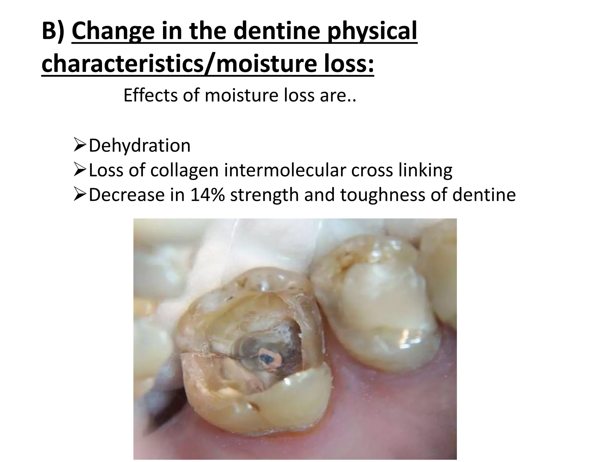 Restoration of endodontically treated teeth | PPTX