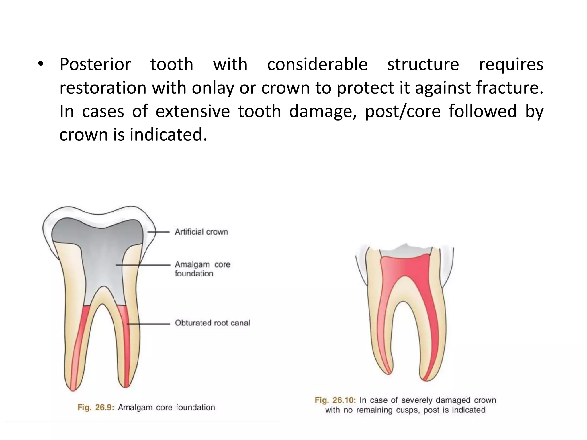 Restoration of endodontically treated teeth | PPTX
