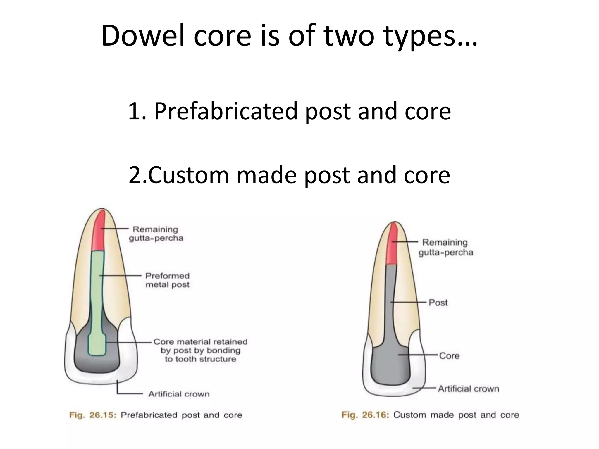 Restoration of endodontically treated teeth | PPTX