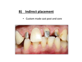 Restoration of endodontically treated teeth | PPTX
