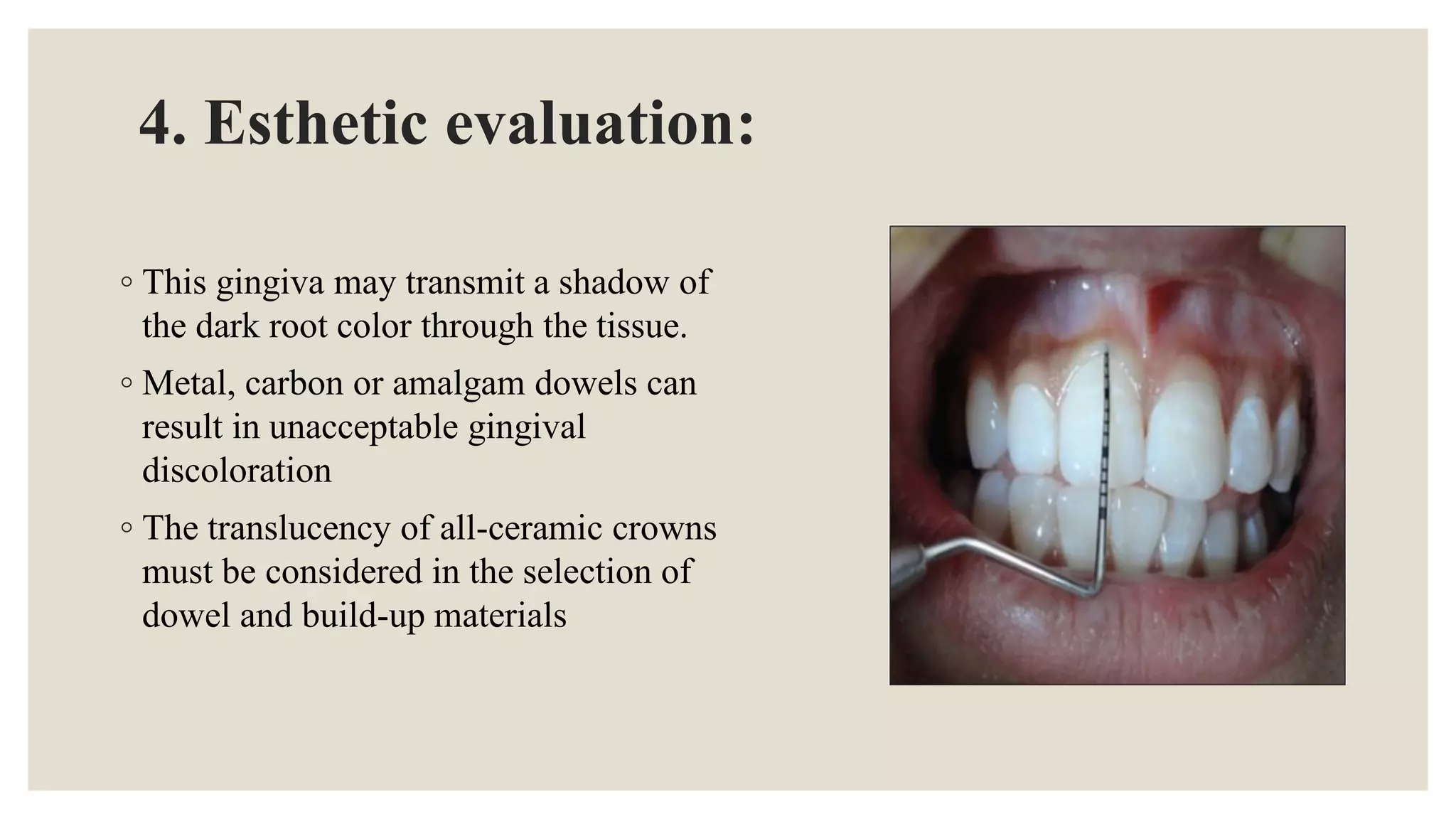 Restoration of endodontically treated teeth | PDF