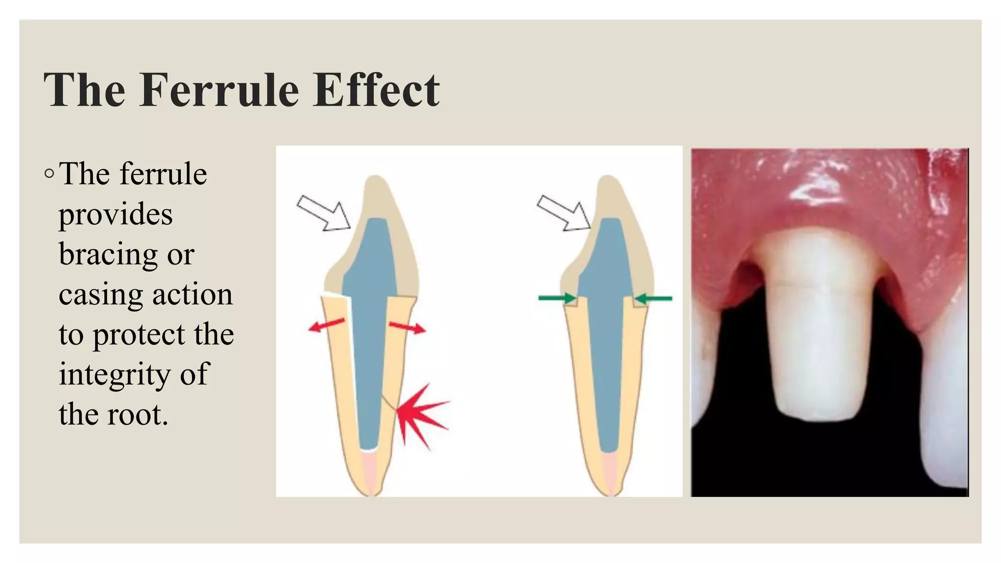 Restoration of endodontically treated teeth | PDF