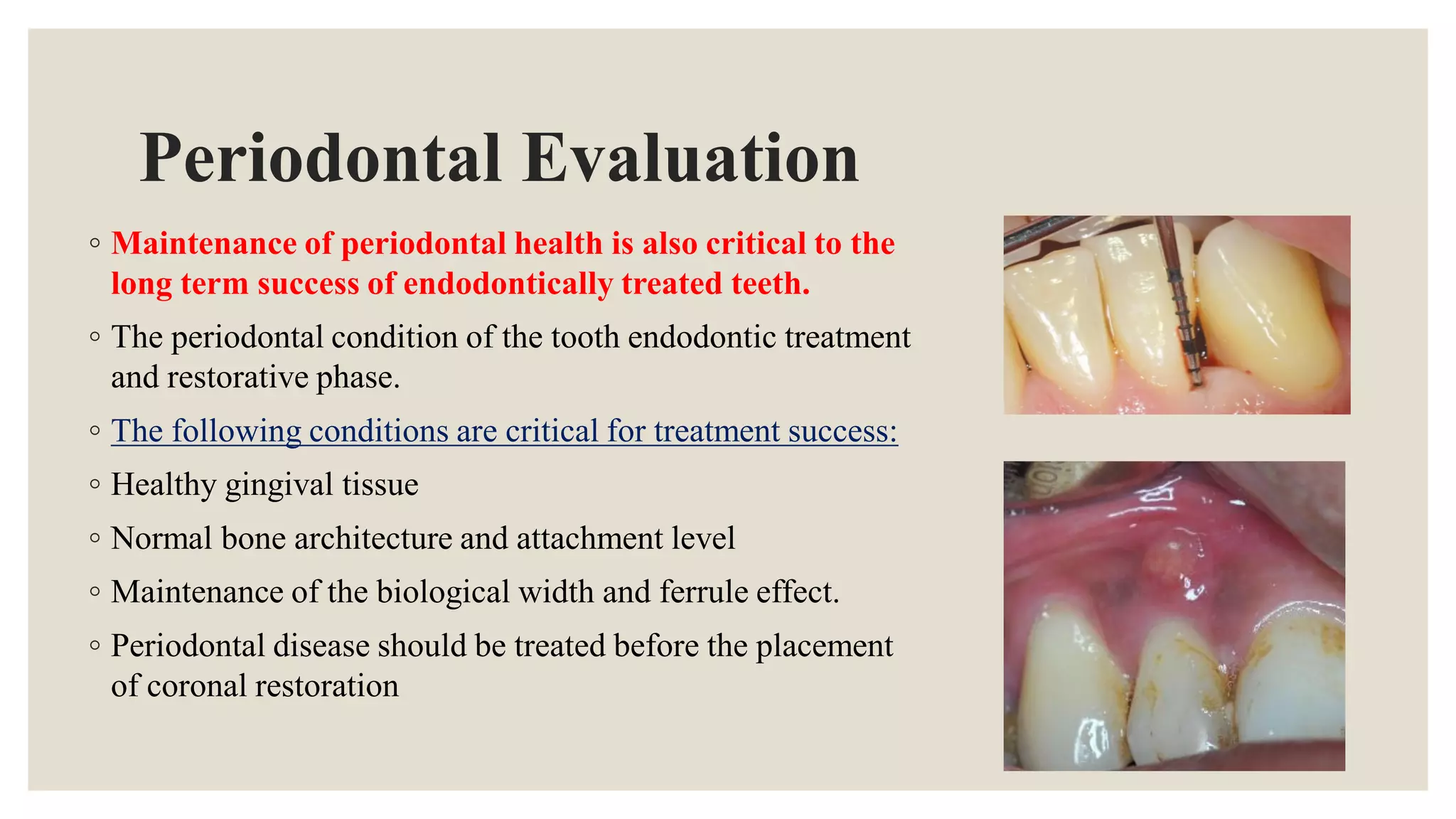 Restoration of endodontically treated teeth | PDF