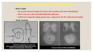 Restoration of endodontically treated teeth | PDF