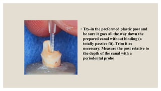 Restoration of endodontically treated teeth | PDF