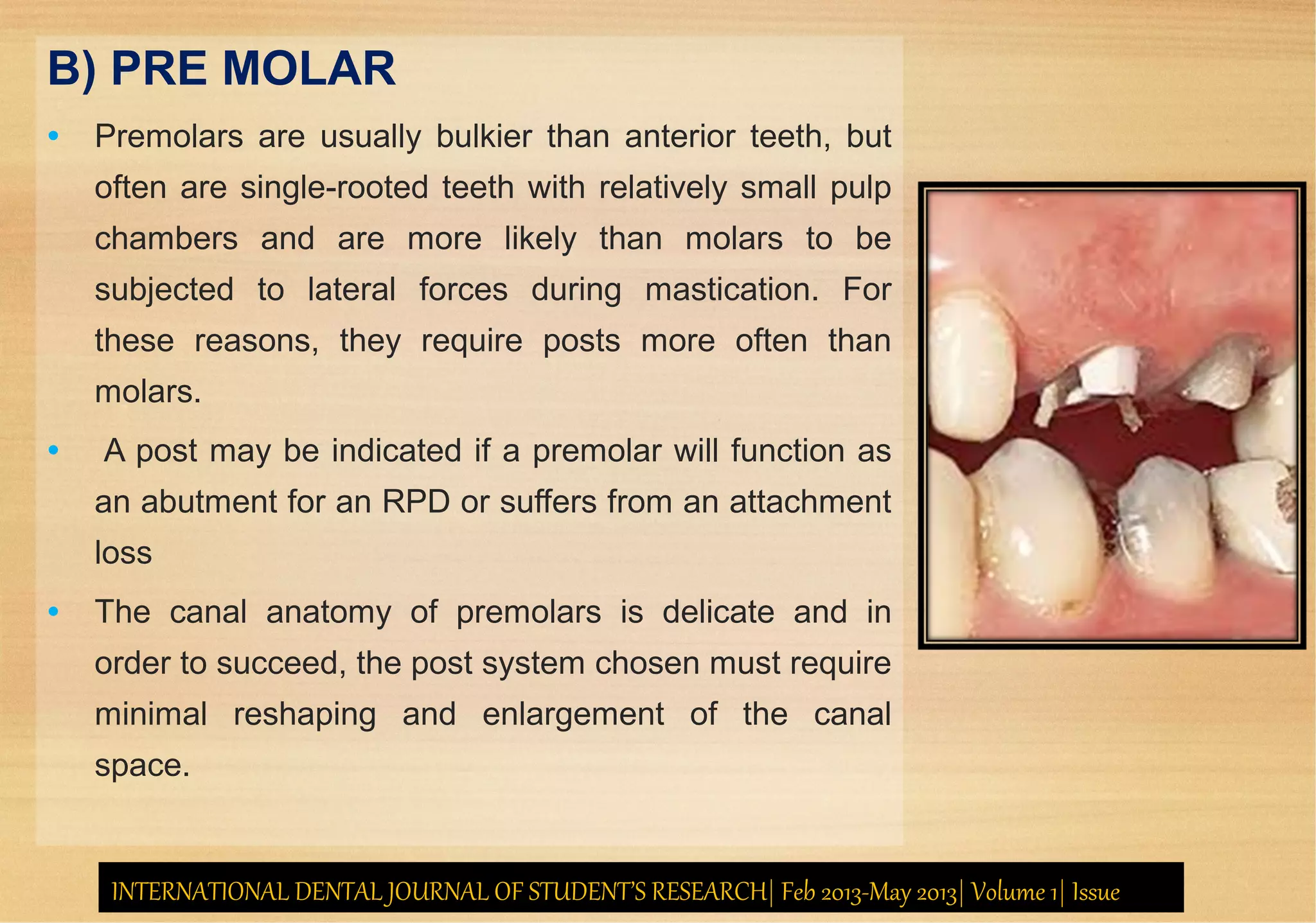 Restoration of endodontically treated teeth | PPT