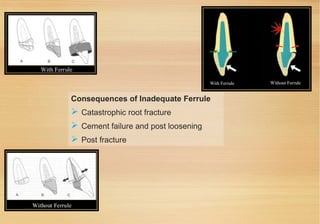 Restoration of endodontically treated teeth | PPT