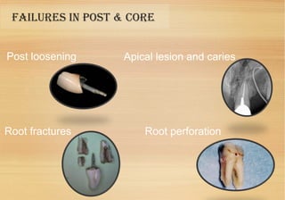 Restoration of endodontically treated teeth | PPT