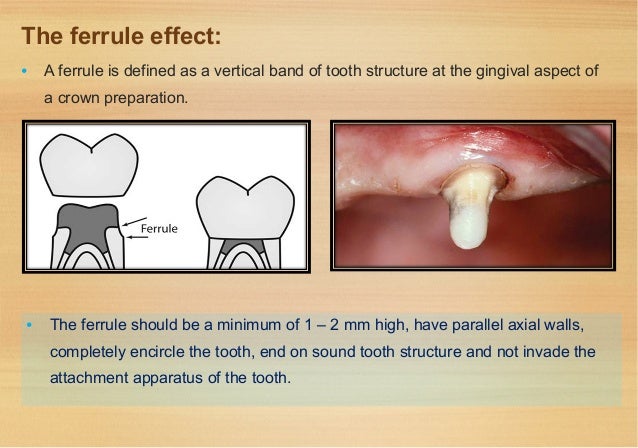 Restoration of endodontically treated teeth