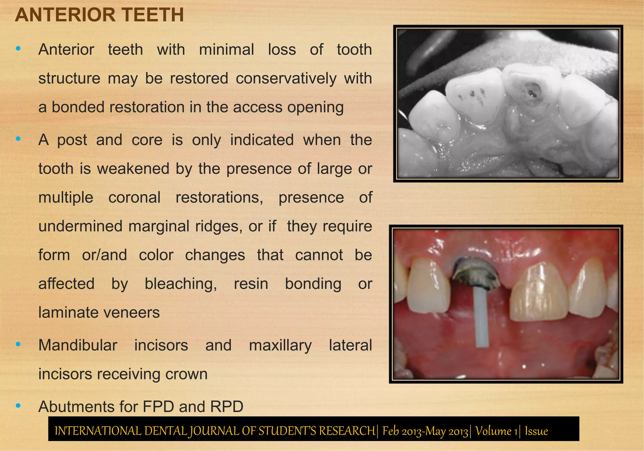 Restoration of endodontically treated teeth. | PPT