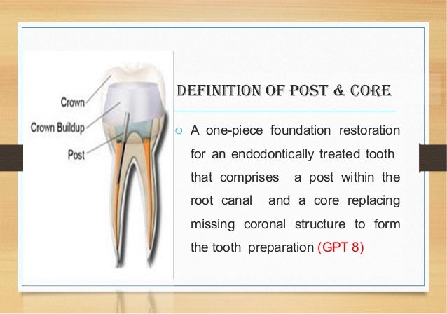 Restoration of endodontically treated teeth.