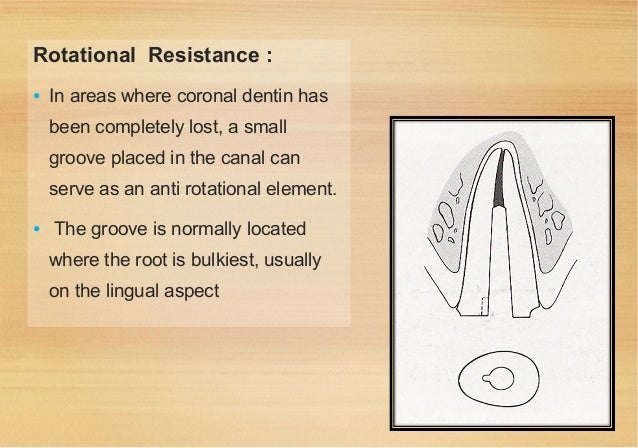Restoration of endodontically treated teeth.