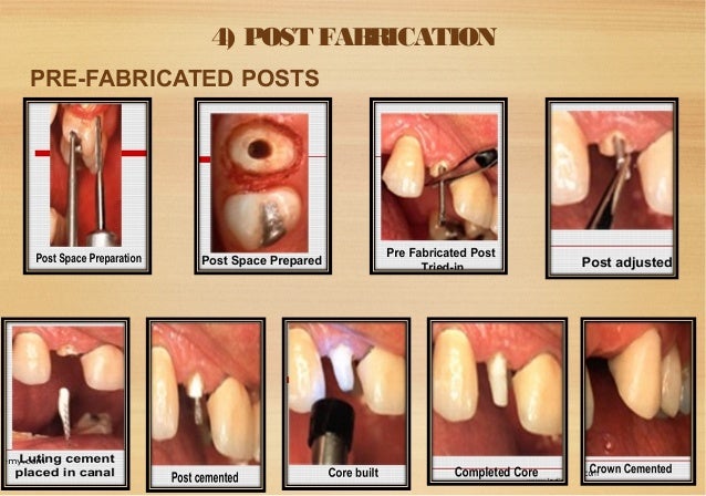 Restoration of endodontically treated teeth.