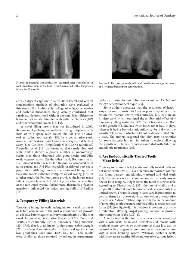 Restoration of endodontically treated teeth review & treatment recomendations | PDF