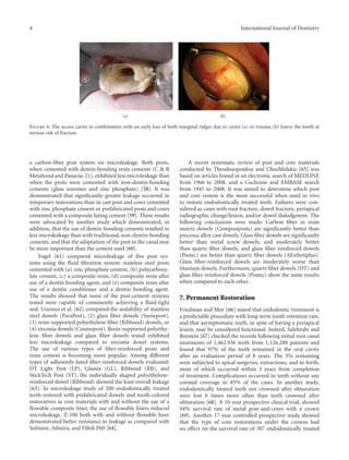 Restoration of endodontically treated teeth review & treatment ...