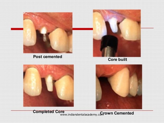 Restoration of endodontically treated tooth/ academy general dentistry
