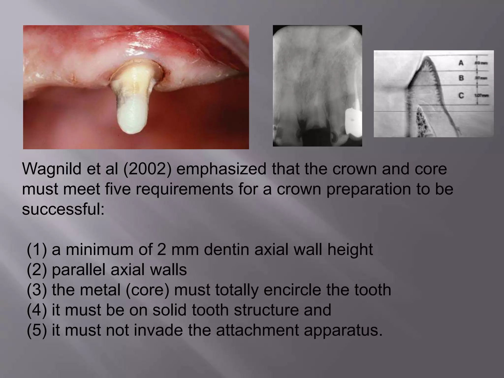 Prosthetic restoration of endodontically treated tooth | PPTX