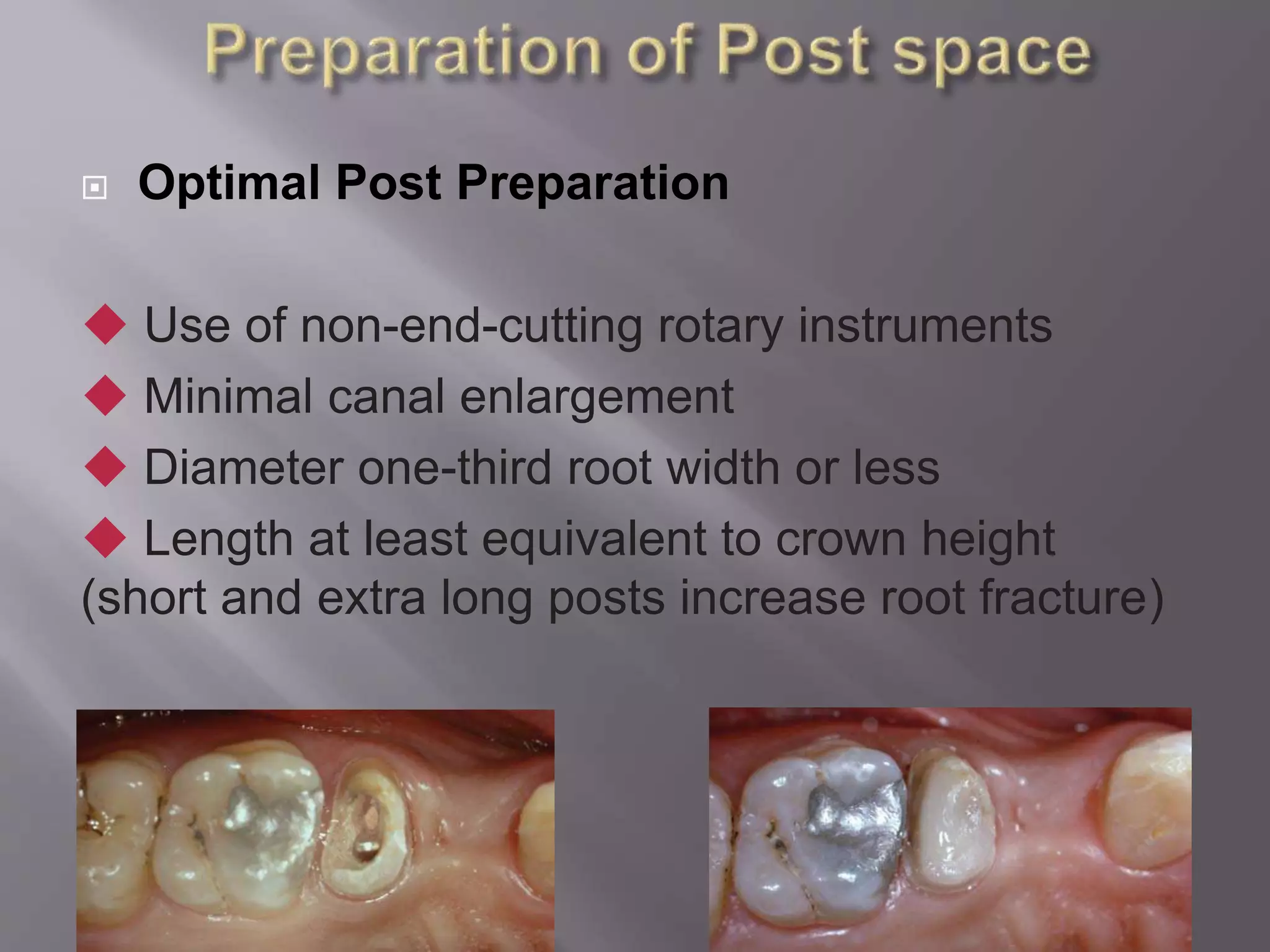 Prosthetic restoration of endodontically treated tooth | PPTX