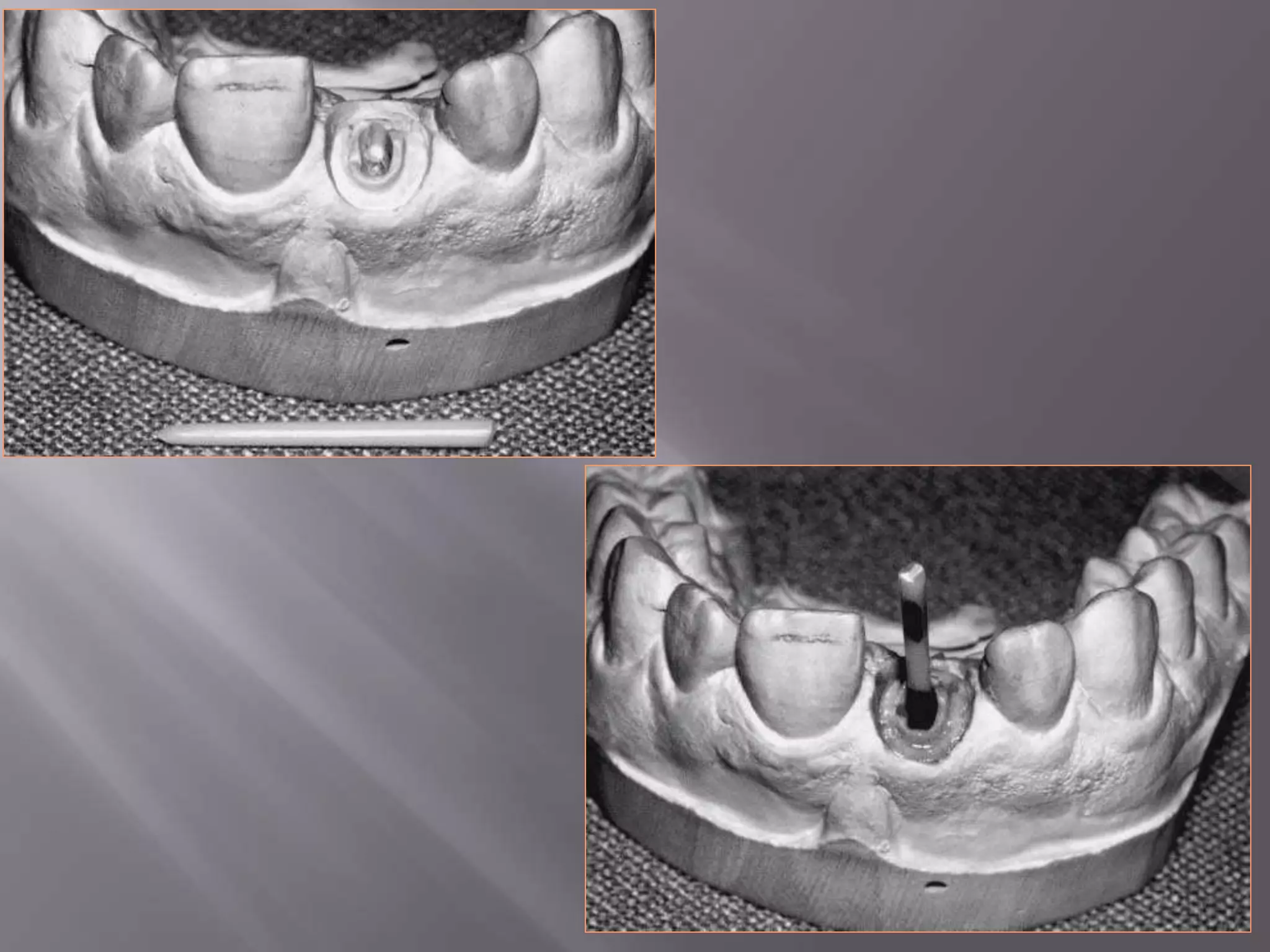 Prosthetic restoration of endodontically treated tooth | PPTX