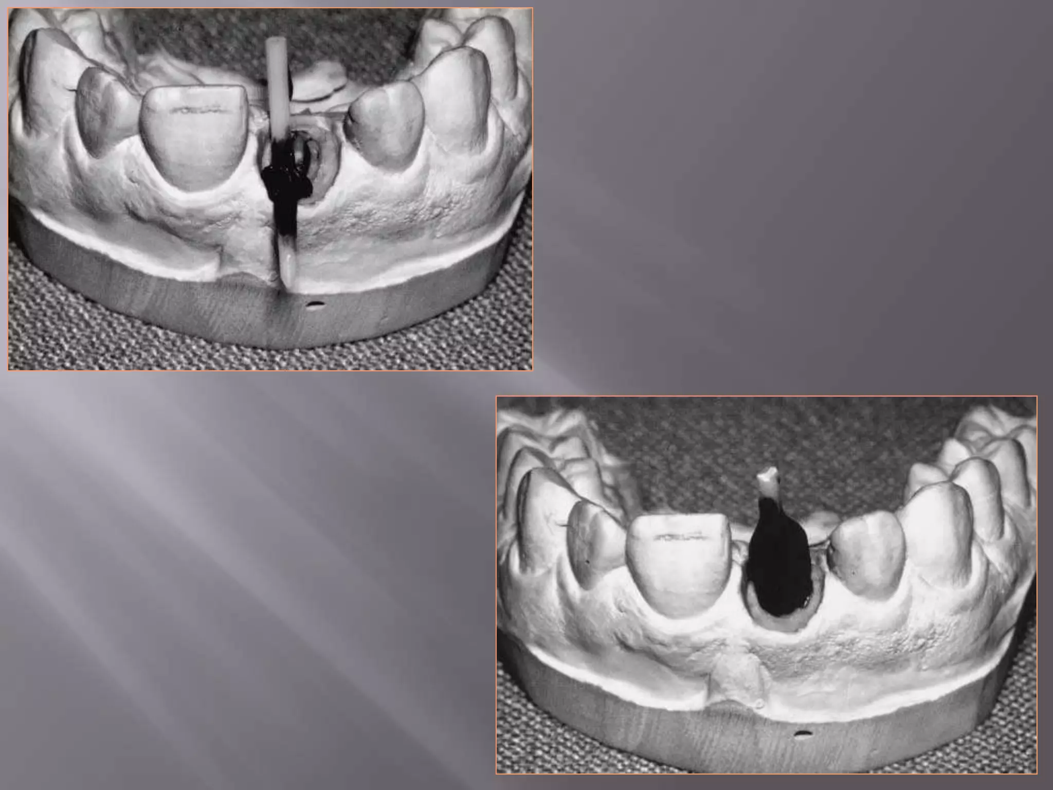 Prosthetic restoration of endodontically treated tooth | PPTX