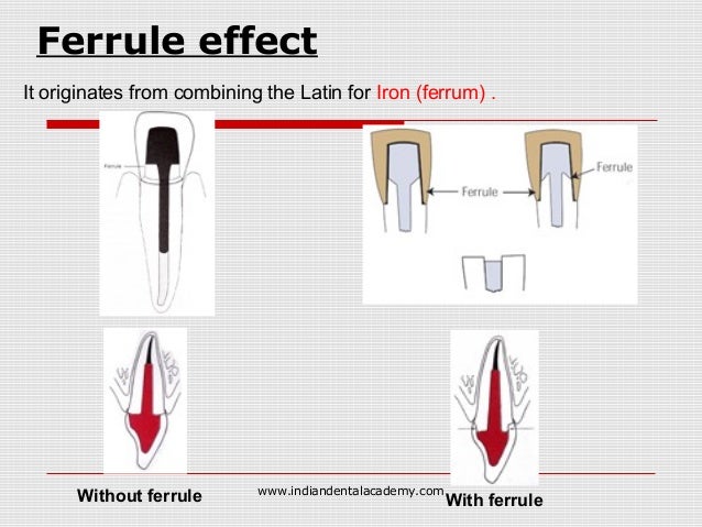 Restoration of endodontically treated tooth/prosthodontic courses