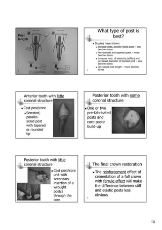 Restoration of enododontically treated teeth | PDF | Free Download