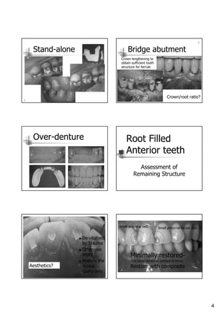 Restoration of enododontically treated teeth | PDF