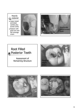 Restoration of enododontically treated teeth | PDF | Free Download