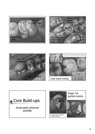 Restoration of enododontically treated teeth | PDF | Free Download