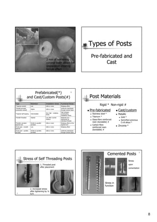 Restoration of enododontically treated teeth | PDF | Free Download