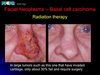 Restoration of facial defects basic priniciples | PPT