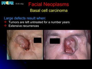 Restoration of facial defects basic priniciples | PPT