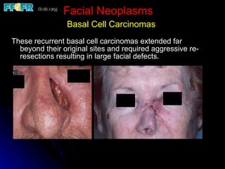 Restoration of facial defects basic priniciples | PPT